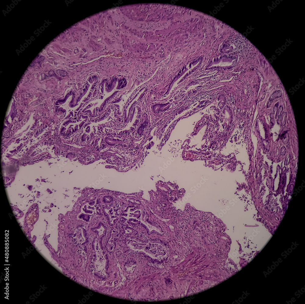 Cholelithiasis of Gallbladder, microphotograph of chronic cholecystitis ...