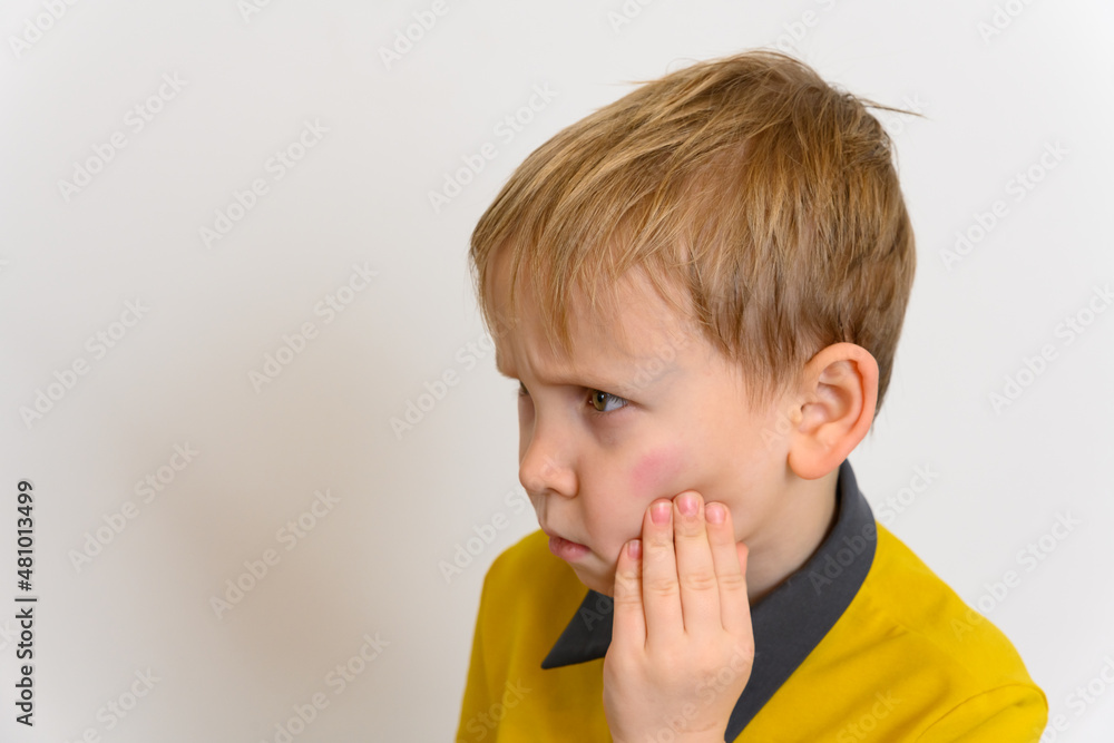 A hematoma on the face under the boy's left eye. Injury in a fall. The ...