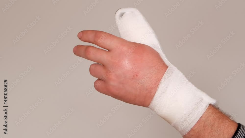 bandages and a splint on the arm .Broken arm.Bandage and splint on the ...