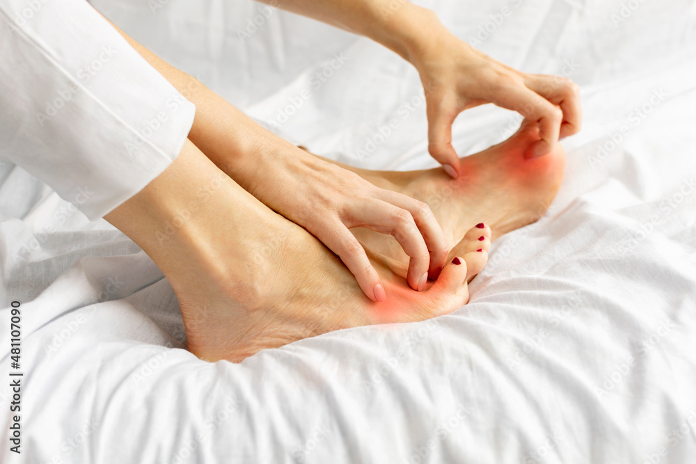 Side view of female hands scratch legs sitting on white bed at home ...