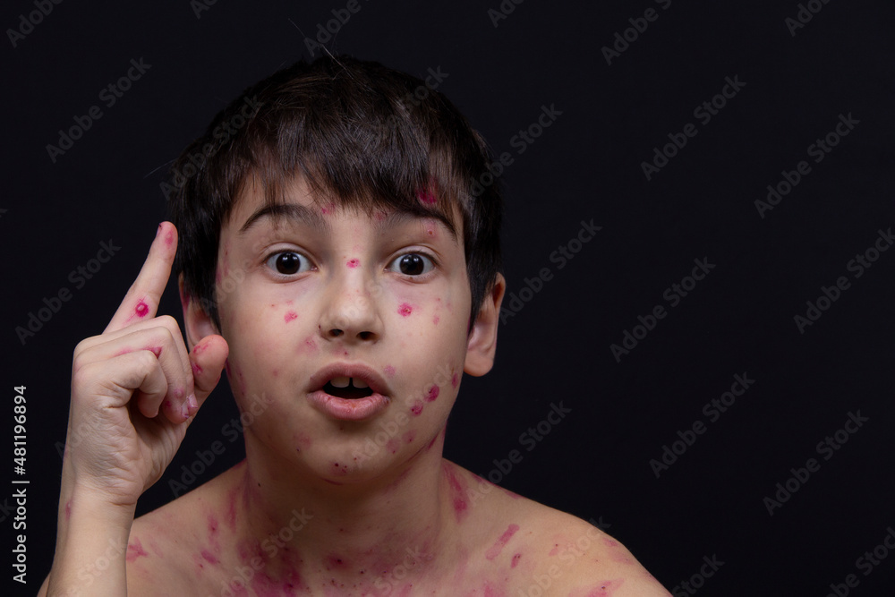 Skin rash in a child. Chickenpox virus. Treatment concept with ...