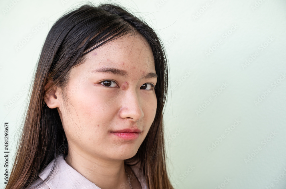 Ugly Asian woman with large pimple (or Elephant head acne) and acne ...