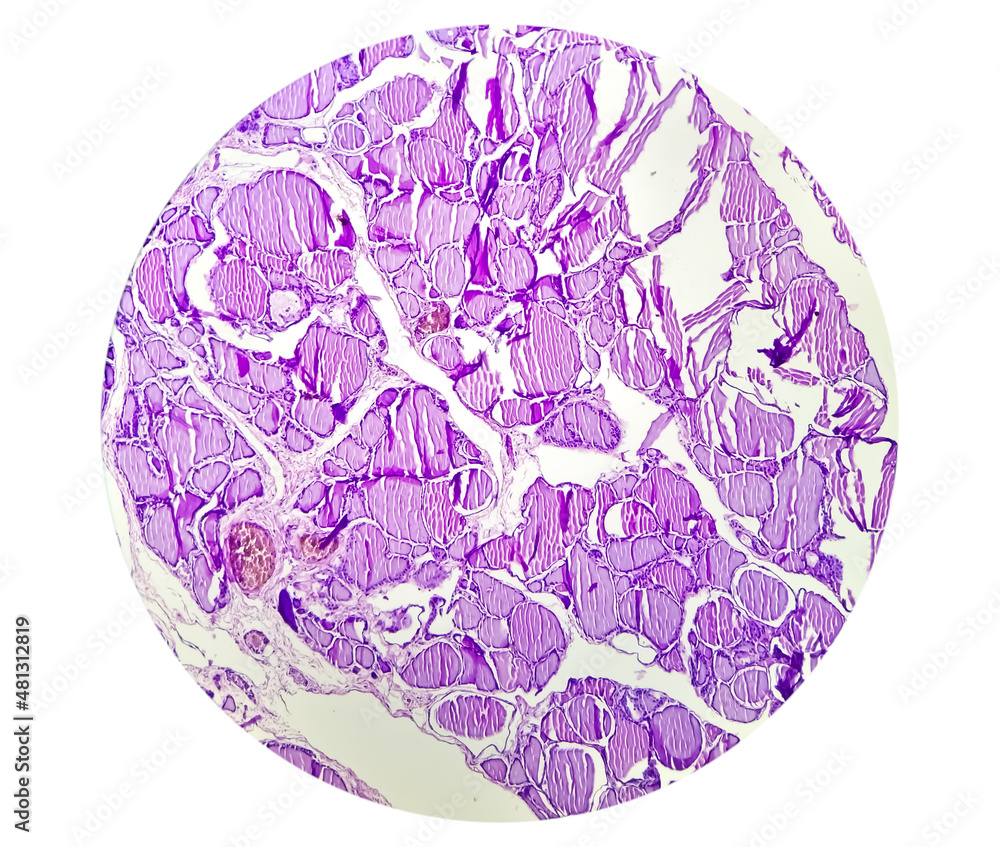 Thyroid cancer: Microscopic image of papillary thyroid carcinoma ...