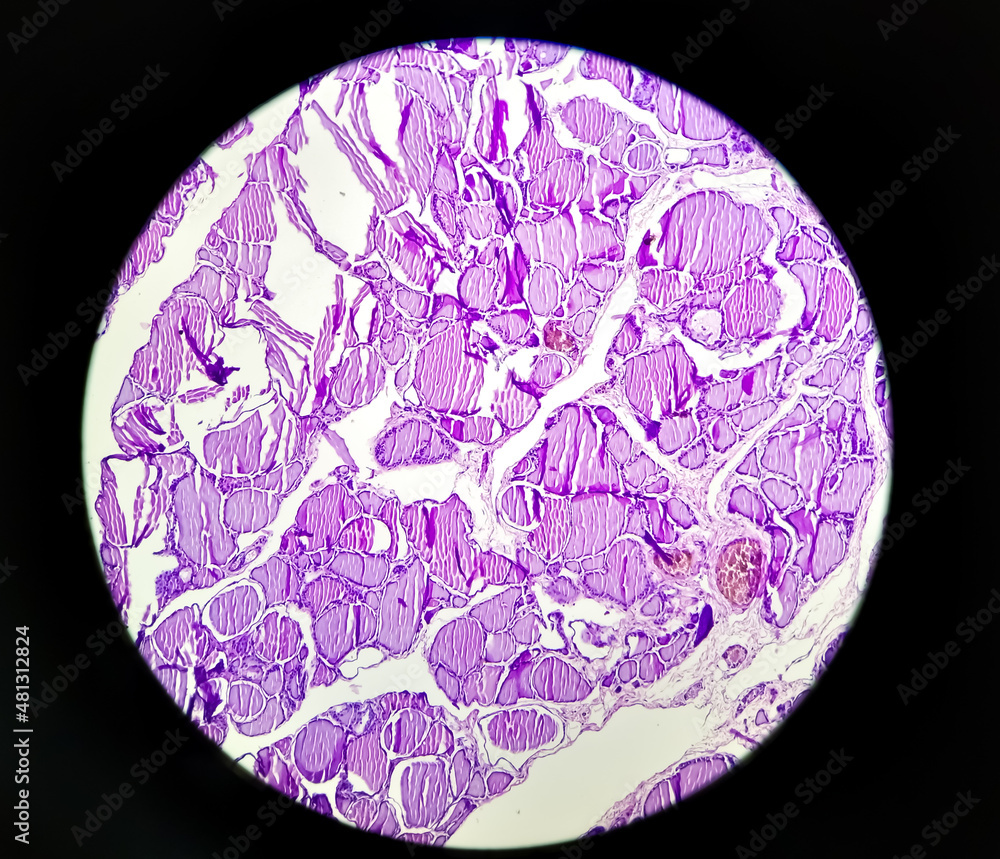Thyroid cancer: Microscopic image of papillary thyroid carcinoma ...
