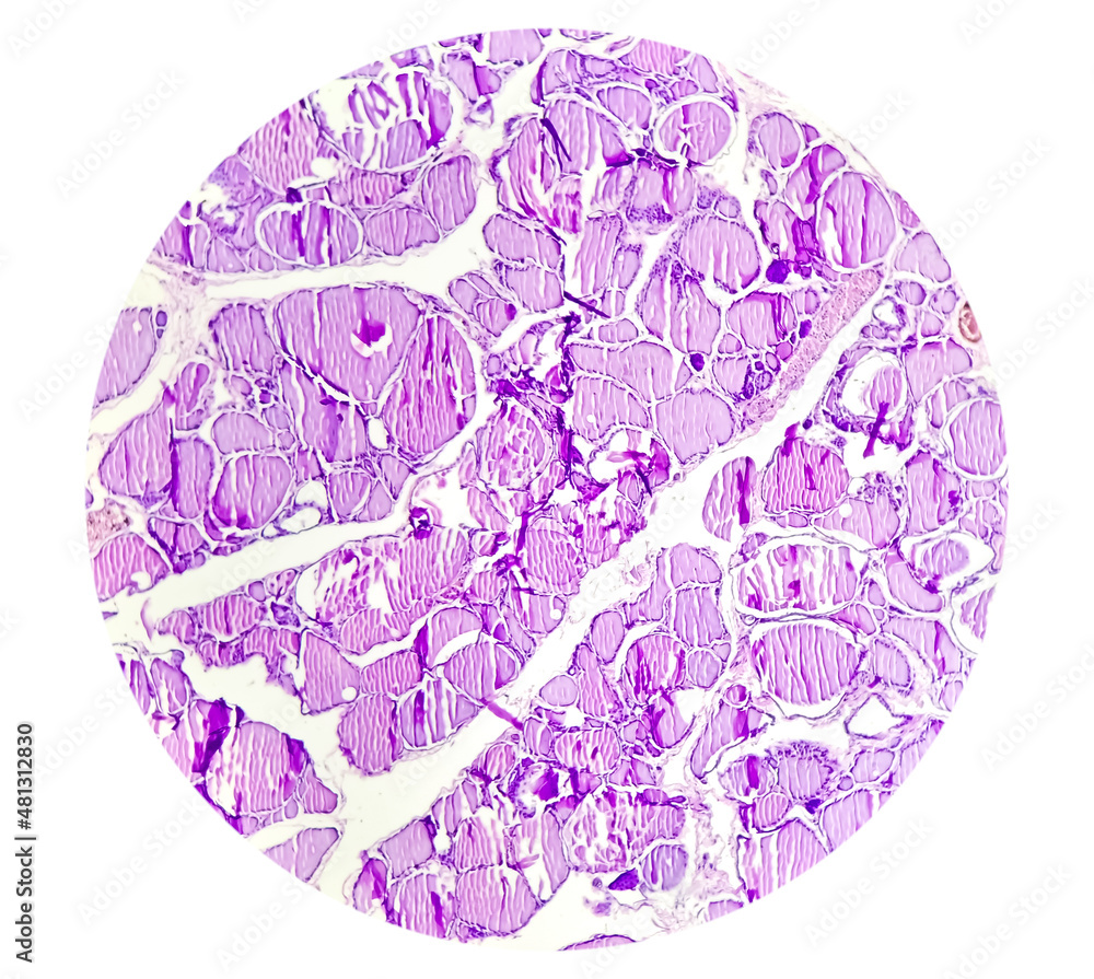 Thyroid cancer: Microscopic image of papillary thyroid carcinoma ...