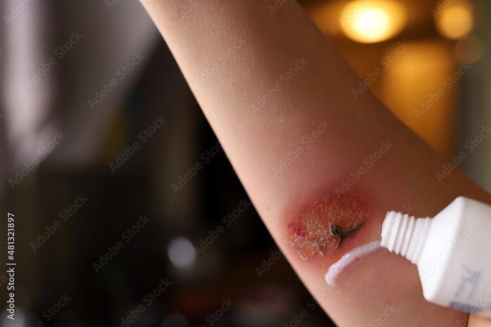burn on the hand, treatment, first aid, application of medicine Stock ...