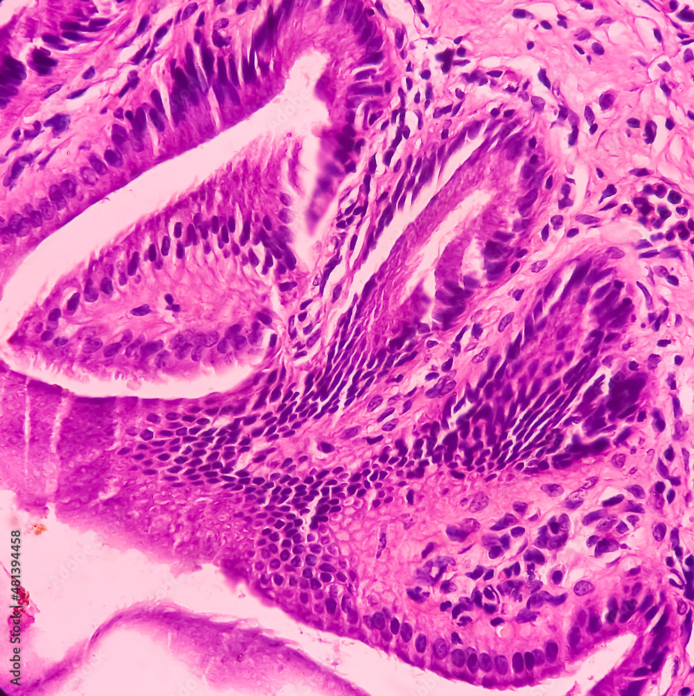 Chronic cholelithiasis of Gallbladder, microphotograph of chronic ...