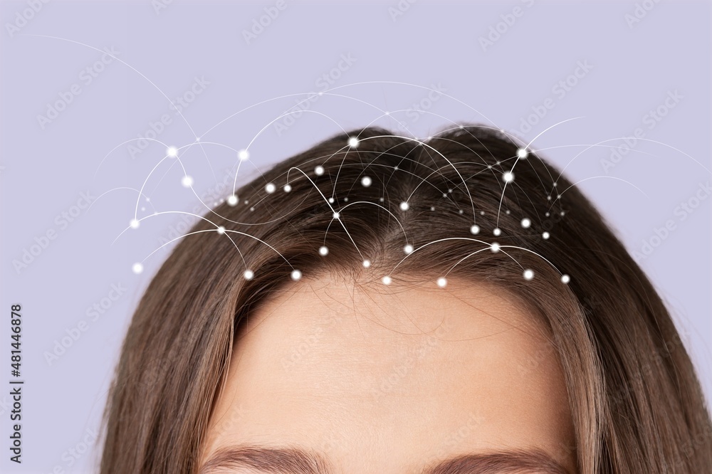 Dandruff problem. A girl with itchy head. Dandruff on the hair disease ...