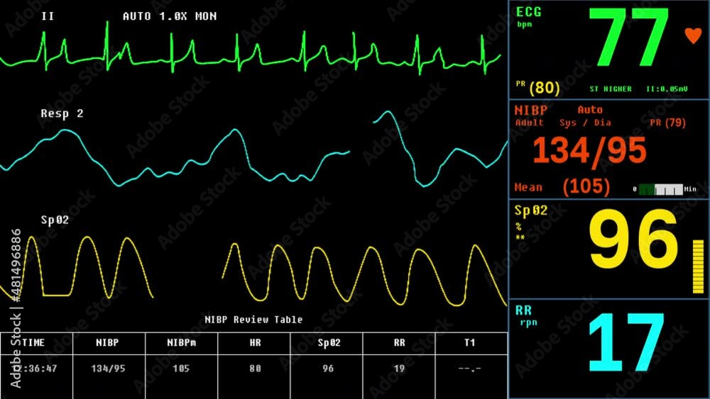 ECG System Ui Monitoring Health Condition Of Patient. Electrocardiogram ...