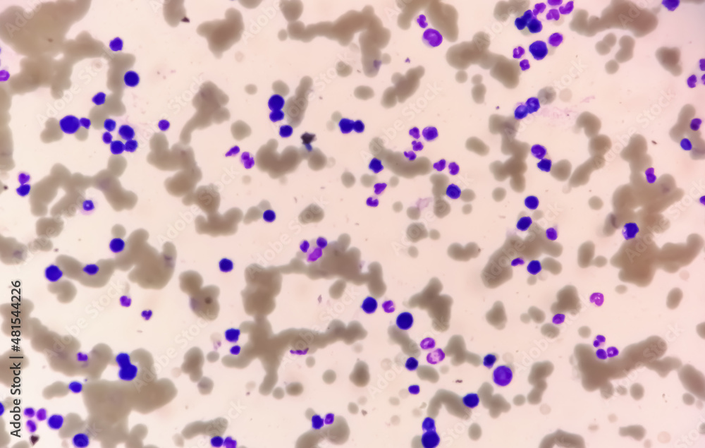 Photomicrograph of blood film, plasma cell leukemia, plenty atypical ...