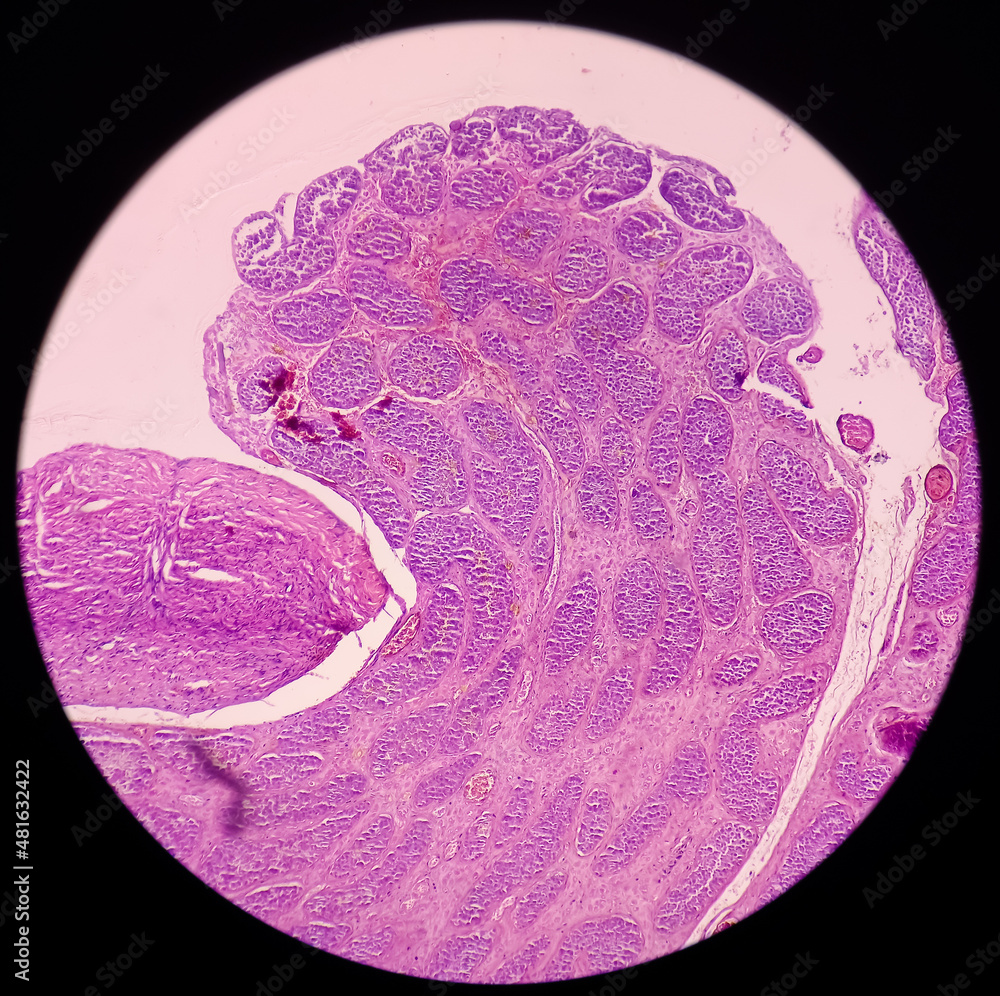 Microscopic Image Torsion Of Testicles Disease Of Male Genital Organs