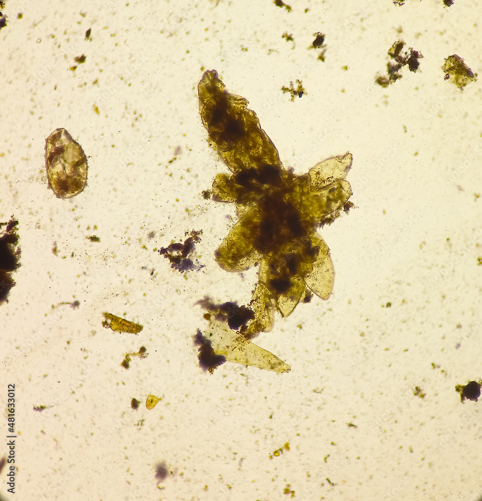 Stool examination under light microscopy, fat globules, plenty yeasts ...