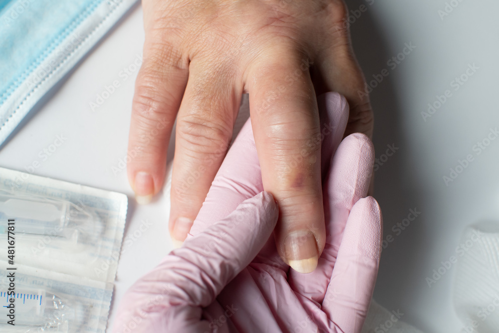 The doctor examines the injury of the female hand. Contusion of the ...