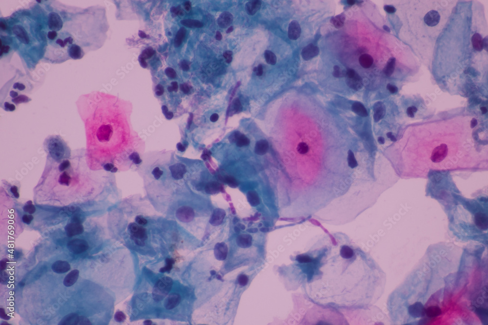 View in microscopic of Candidiasis, fungus infection (Yeast and ...