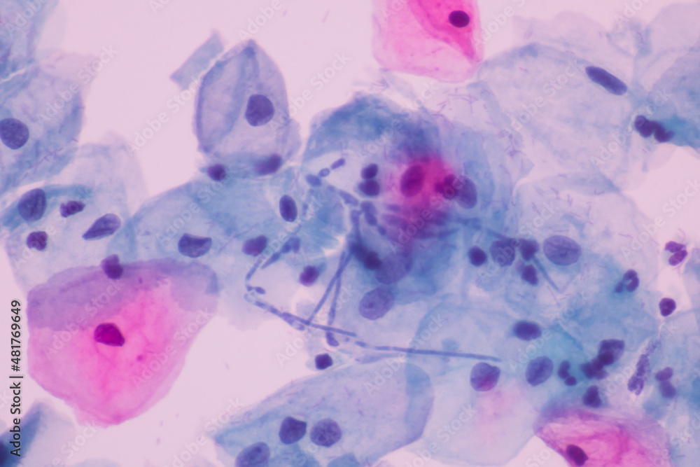 View in microscopic of Candidiasis, fungus infection (Yeast and ...