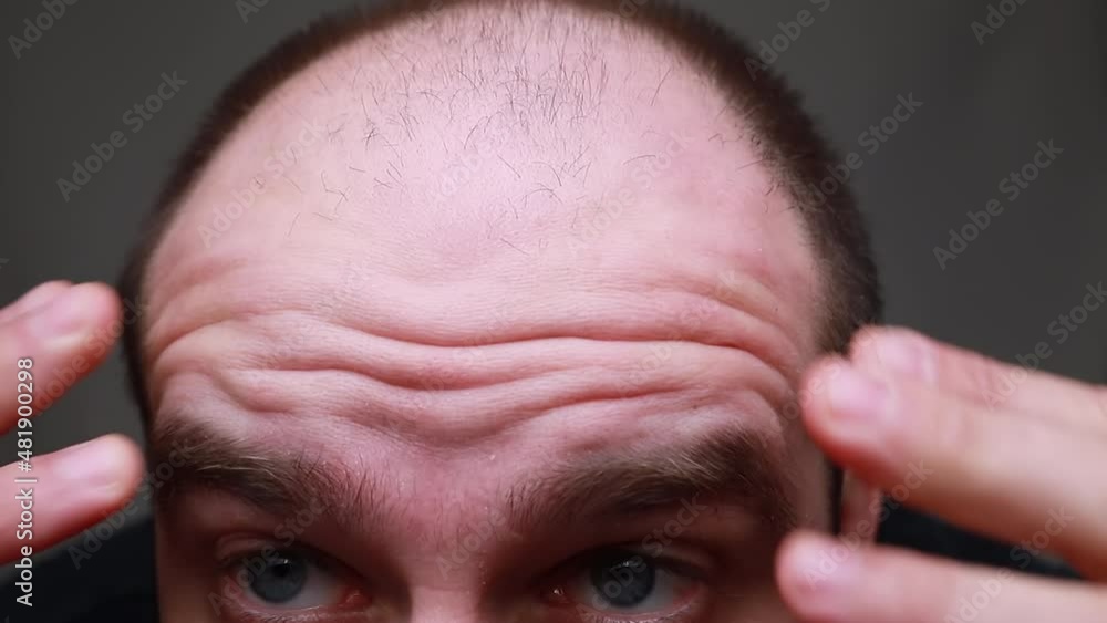 Wrinkles on a man's forehead, close-up. Facial expression. Wrinkle ...