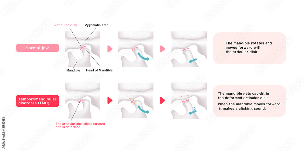 Comparison illustration of normal jaw and Temporomandibular disorders ...