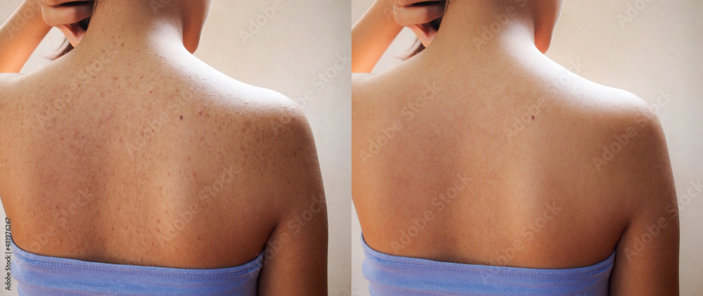 Image before and after treatment spot scar acne pimples on skin back of ...