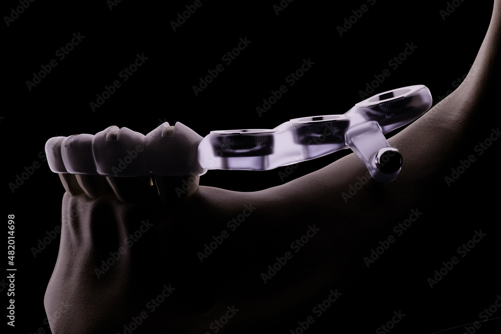 Surgical guide Stock Illustration | Adobe Stock