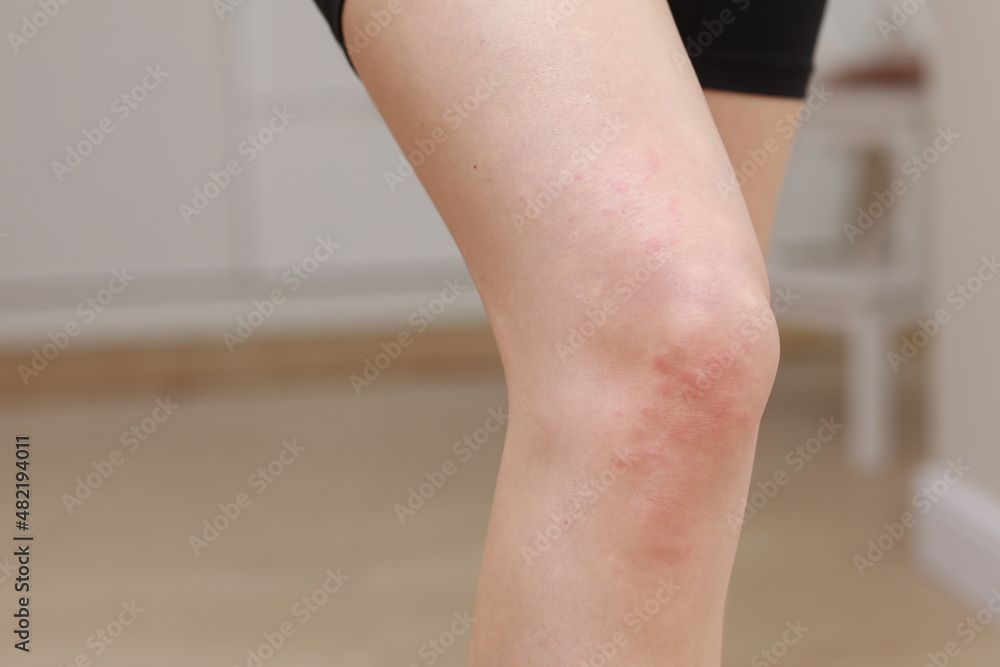 skin allergies, legs skin women. Closeup of red pustules on a knee, an ...
