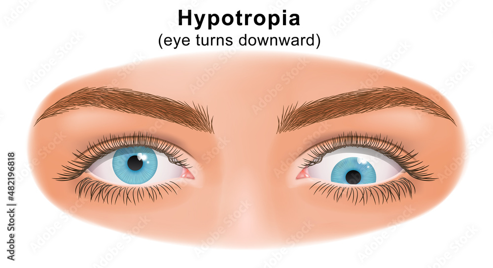 Squint eye (Strabismus). Hypotropia, eye turns upward. Deflection of ...