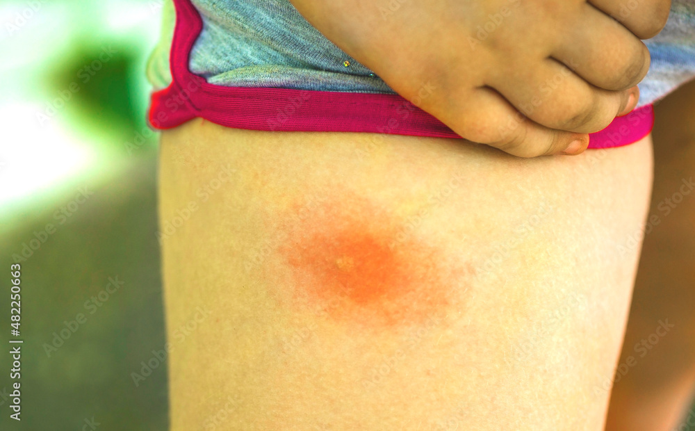 The tick bite on the leg, close-up. Allergy to insect bites.Wound and ...