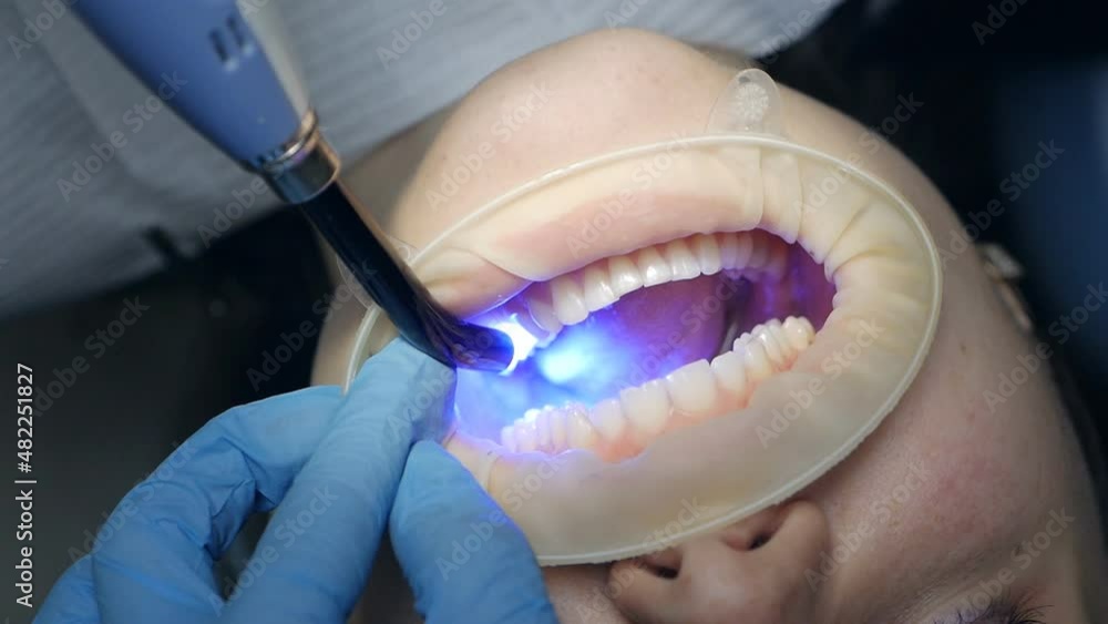 Video Stock Close up of patient with cheek retractor in mouth at dental ...