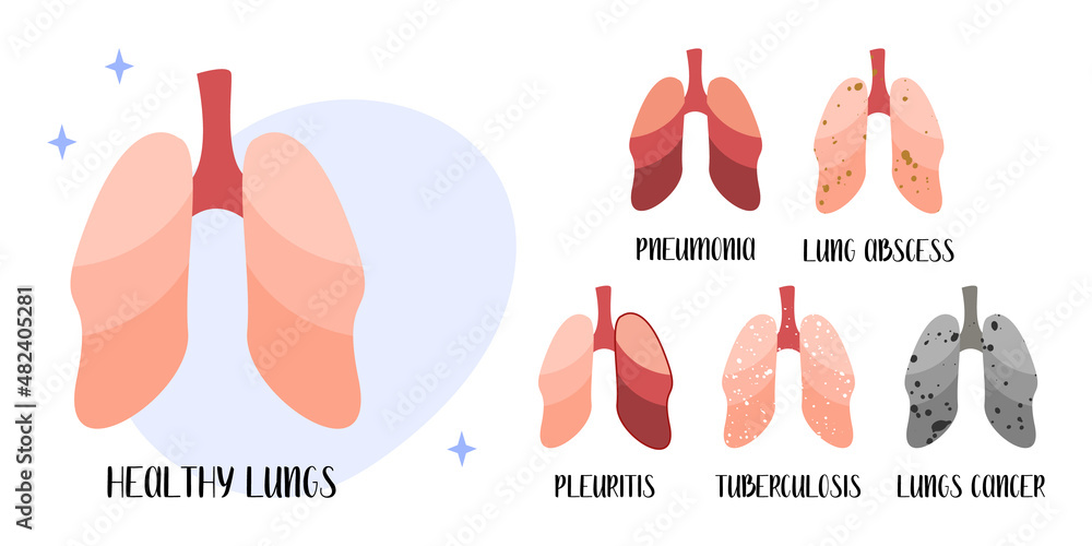 Healthy lungs, respiratory system. Diseases: pneumonia, lung abscess ...