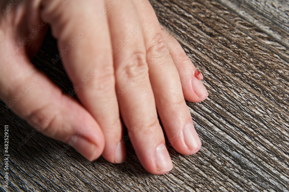 neoplasm on the arm. growth above the nail on the little finger ...