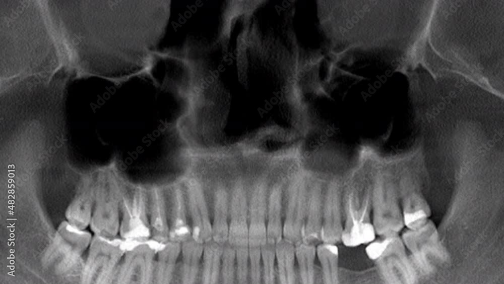 Scanning of the human skull and teeth, x-ray, panorama Stock Video ...