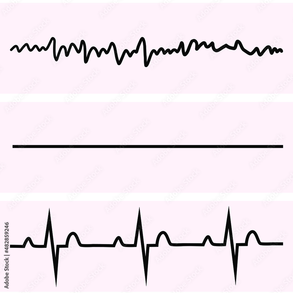 EKG pattern during cardiac arrest including VF asystole and PEA Stock ...