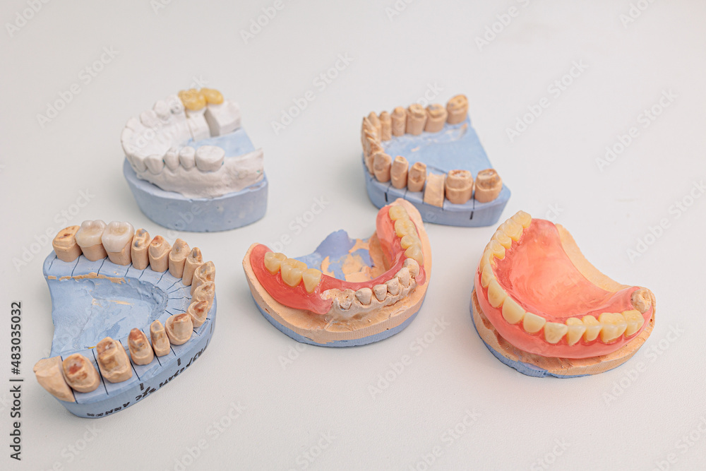 Dentures on a white background. Close-up of dentures. Full removable ...