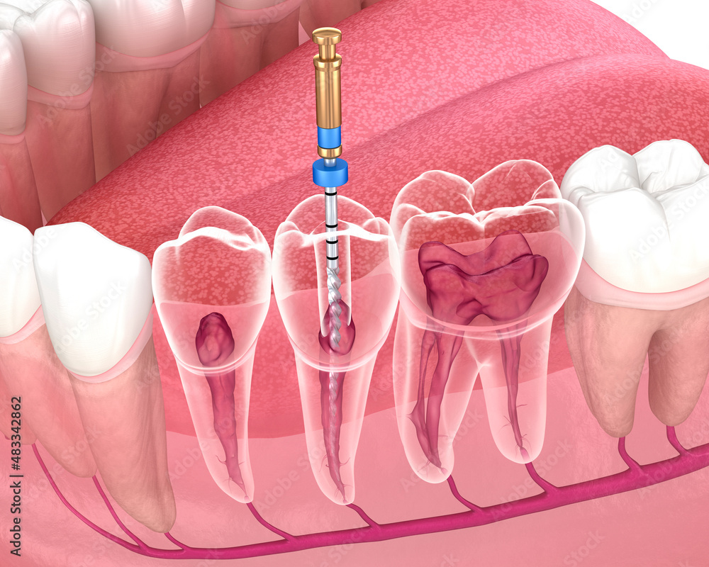 Endodontic root canal treatment process. Medically accurate tooth 3D ...