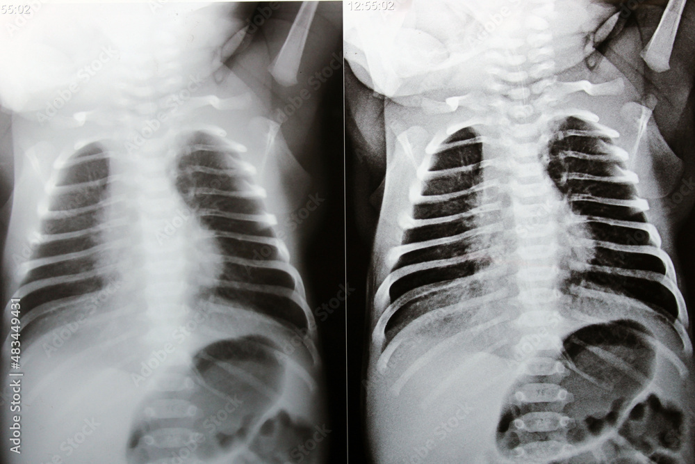 Selective focus of a plain chest x ray for a newborn infant in ...