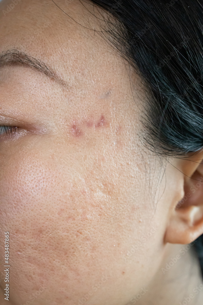 Portrait of worrying asian woman with problems of acne inflammation ...