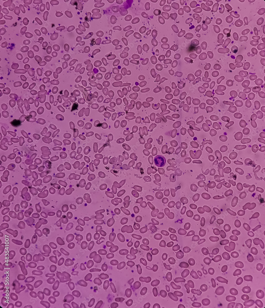 Hereditary elliptocytosis, hereditary disorder of RBCs, Ovalocytes or ...