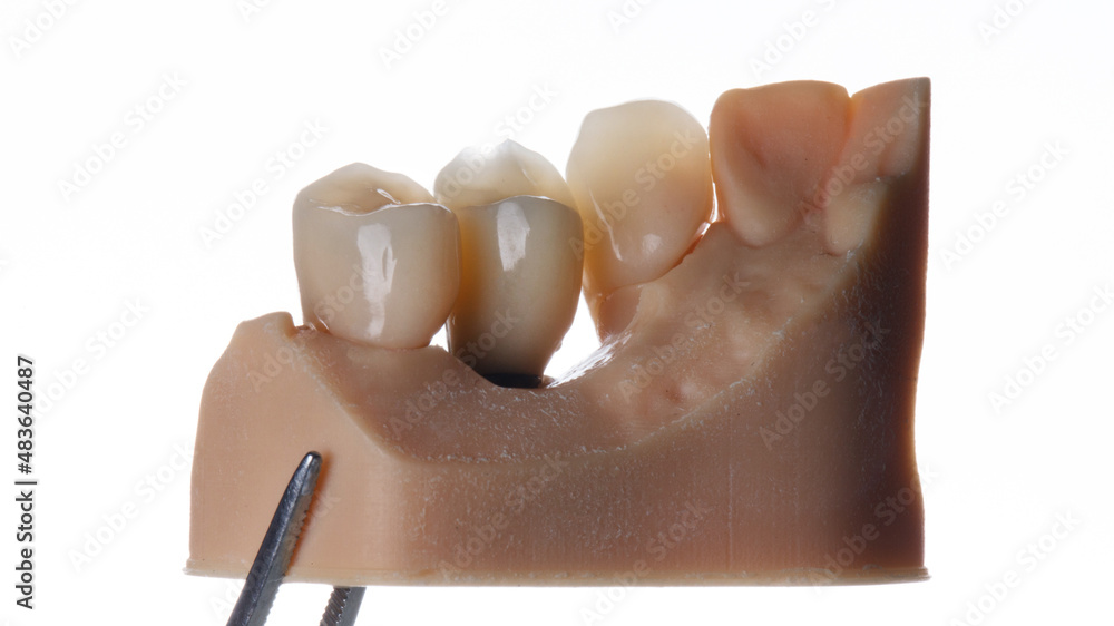 temporary dental crowns made of polymer on a special model on a white ...