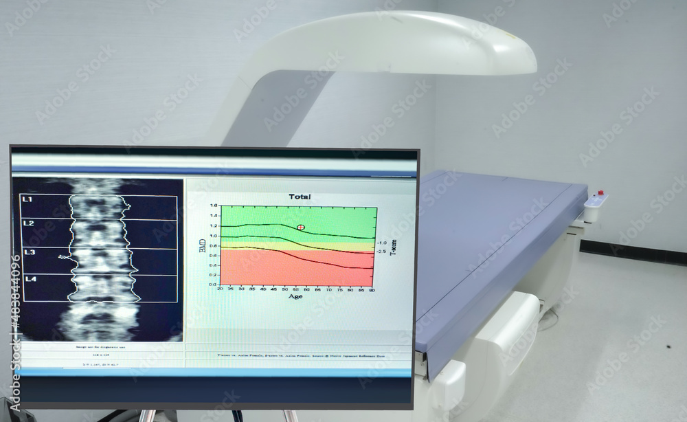 Medical bone density room and bonedensity lumbar spine report on ...