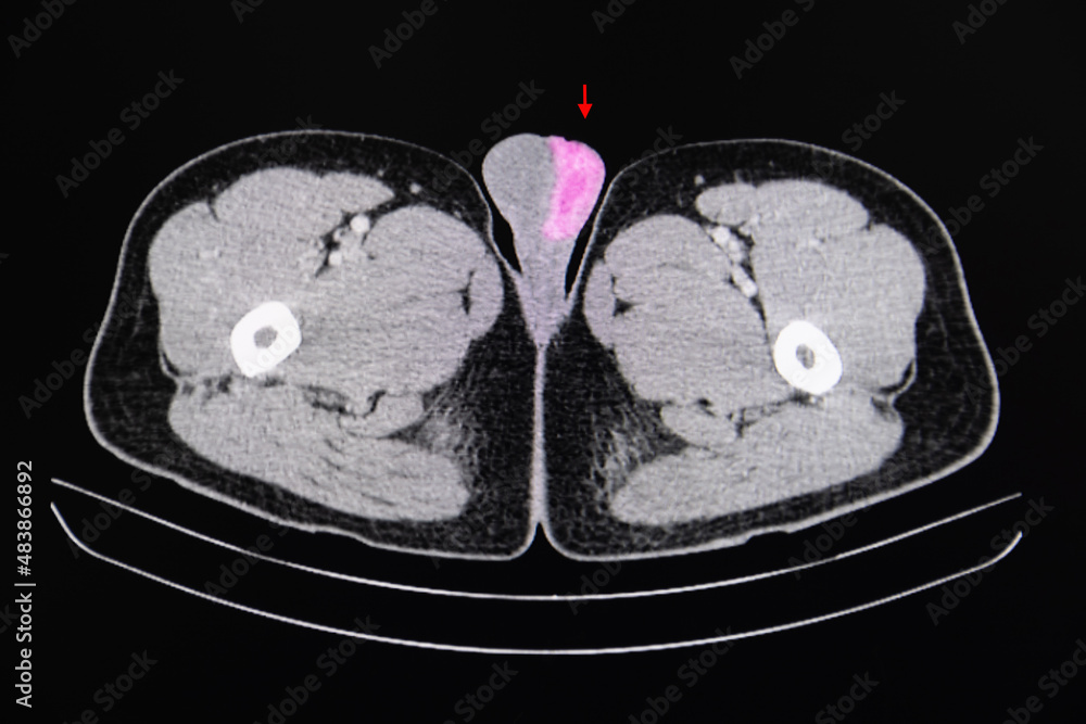 Poster A CT scan of a patient with testicular cancer. – Wall Art ...