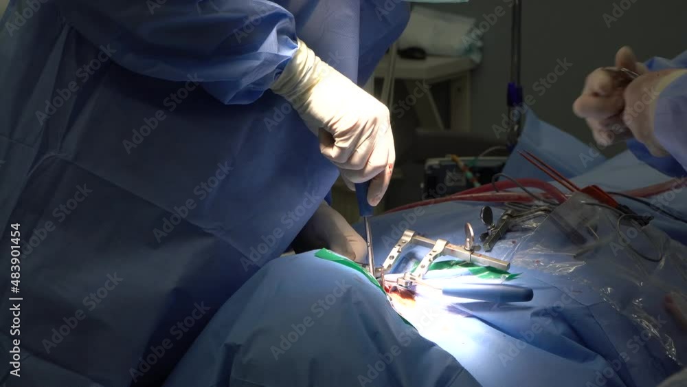 Minimally invasive spine surgery, also known as MISS, has no specific ...