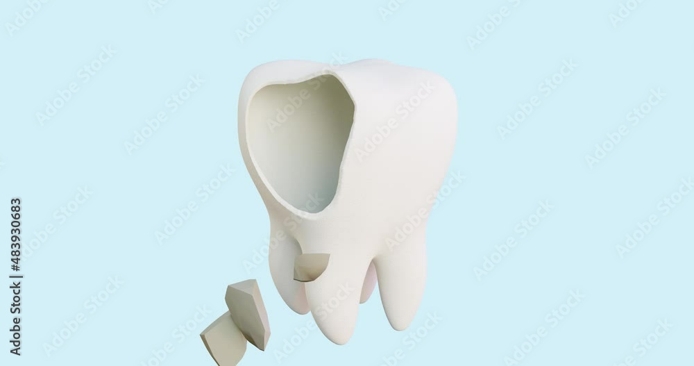 3d animation of tooth enamel destruction in stages spot, caries, dentin ...
