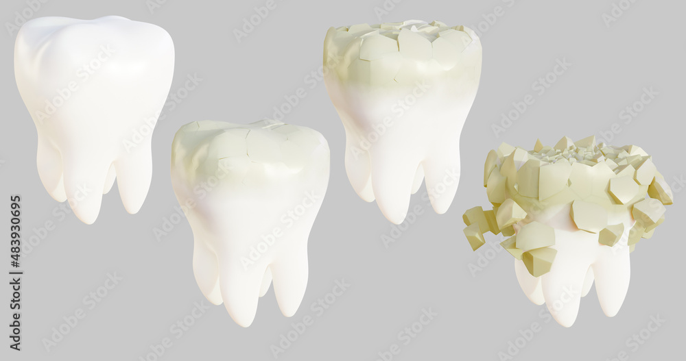3d illustration render of tooth enamel destruction in stages caries ...