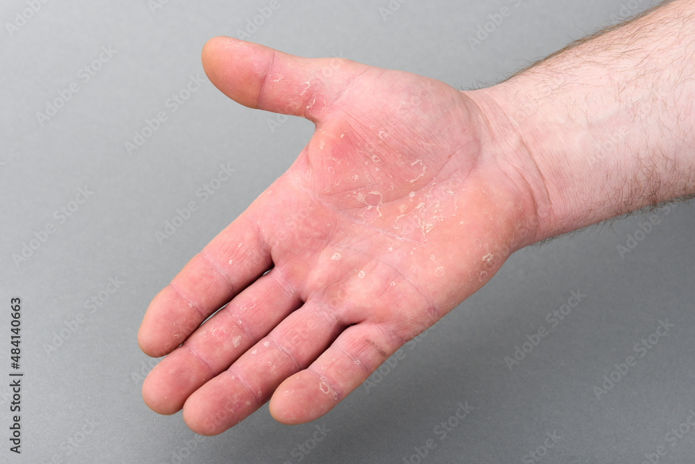 Dry man's hand with skin peeling off. Eczema dermatitis. Stock Photo ...