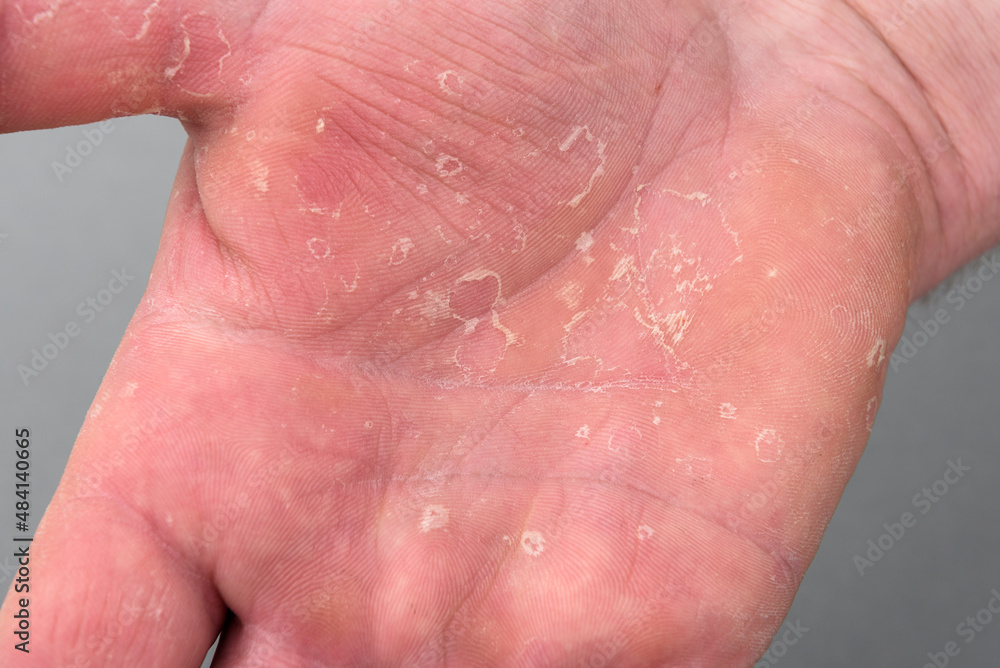 Dry man's hand with skin peeling off. Eczema dermatitis. Stock Photo ...
