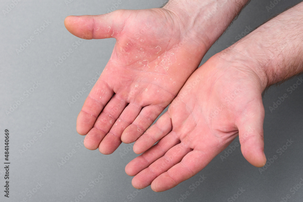 Dry man's hand with skin peeling off. Before and after eczema ...