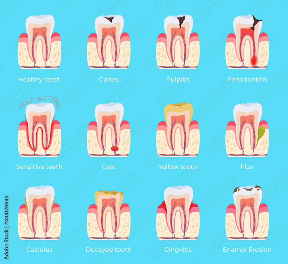 Dental disease with names collection vector flat illustration ...