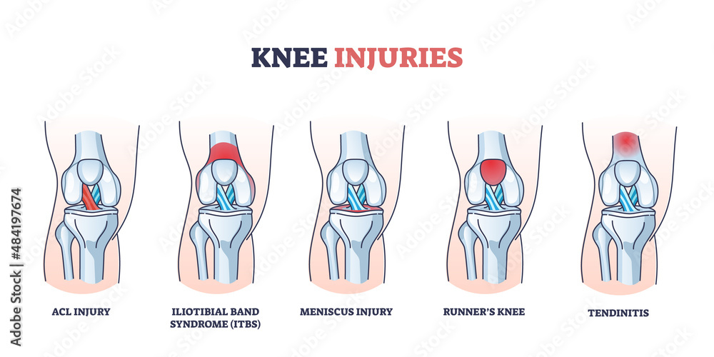Knee injuries with medical bone, ligament or muscle trauma outline ...