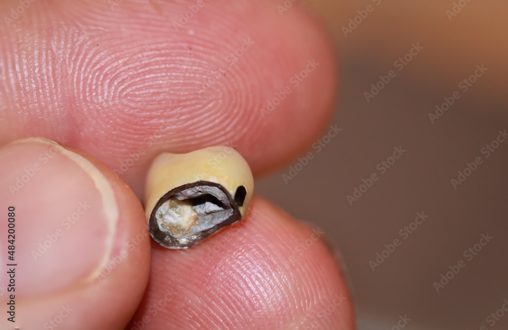 Eine sich gelöste und herausgefallene Krone von einem Zahn. Stock Photo ...