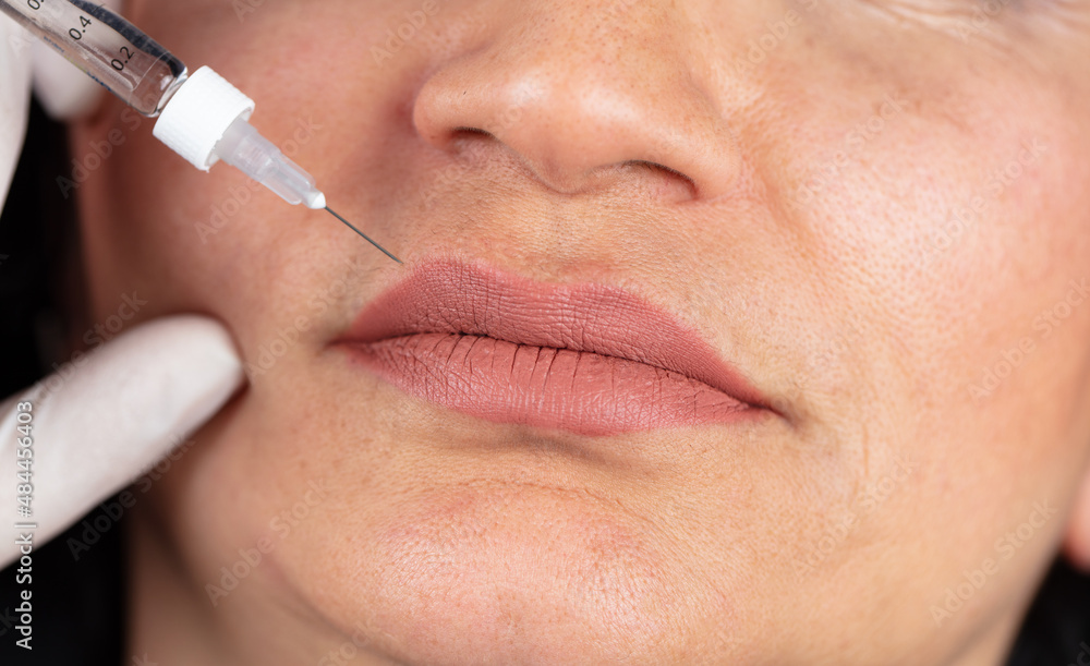 lady getting botox injection for bigger, fuller lips. The woman in the ...