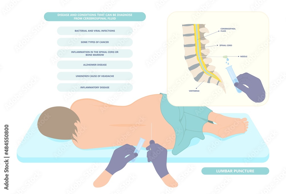 Lumbar puncture for infalmmation Bleeding cancer brain inject ...